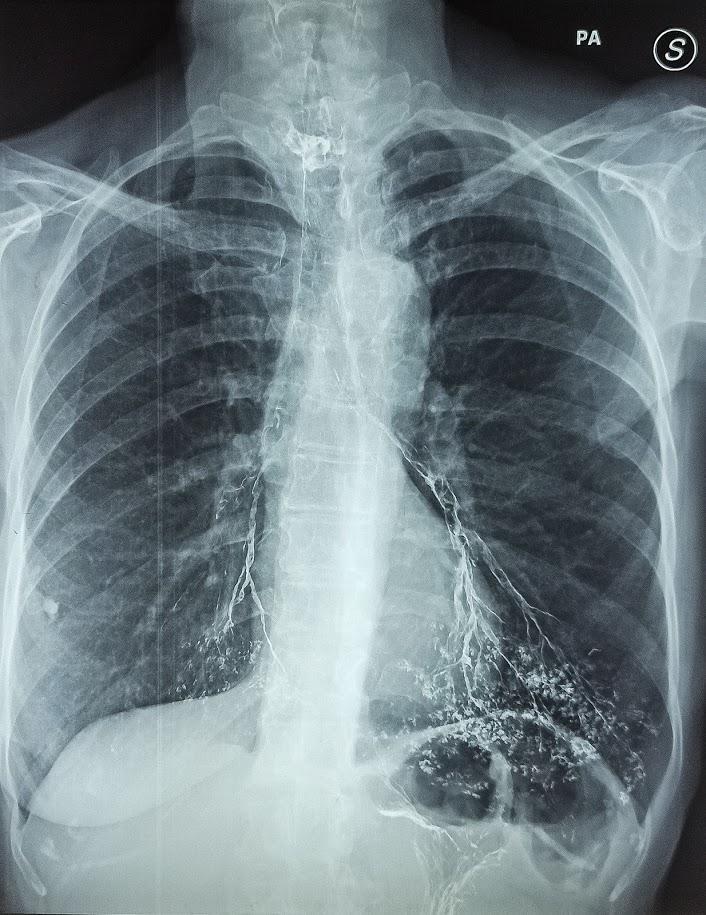 Barium swallow gone wrong | Scrolller
