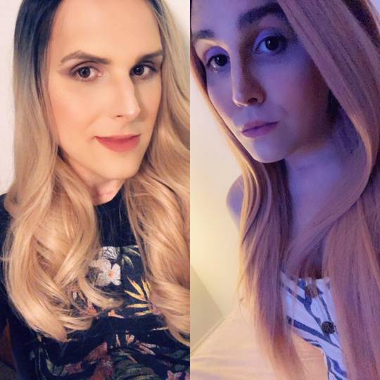 Before/After • 1 year 2 months post op ffs with Dr Toby Mayer in Beverly Hills | Scrolller