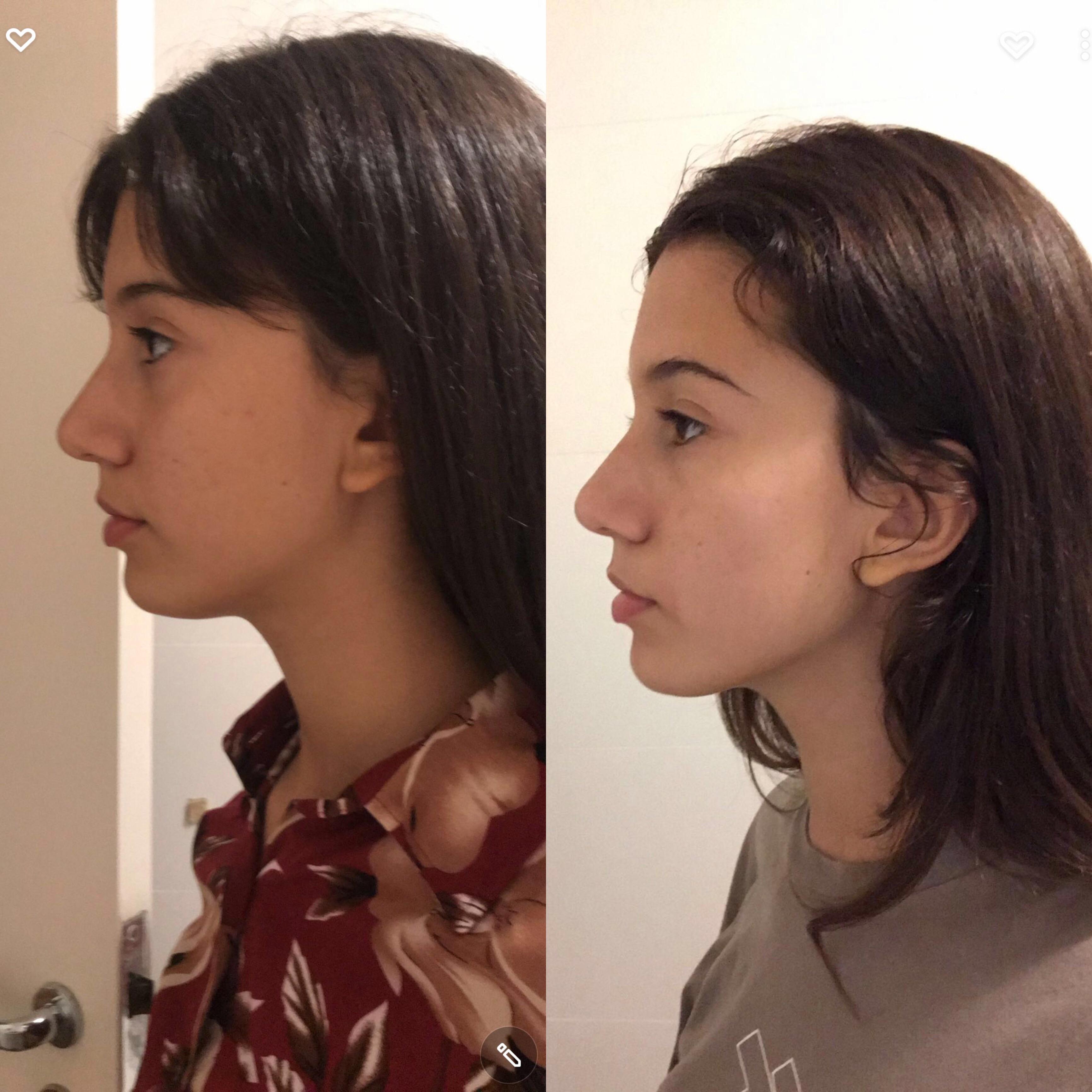 Before and after. Am I tripping or is there a slight difference? (16F, about 3 months of mewing ...
