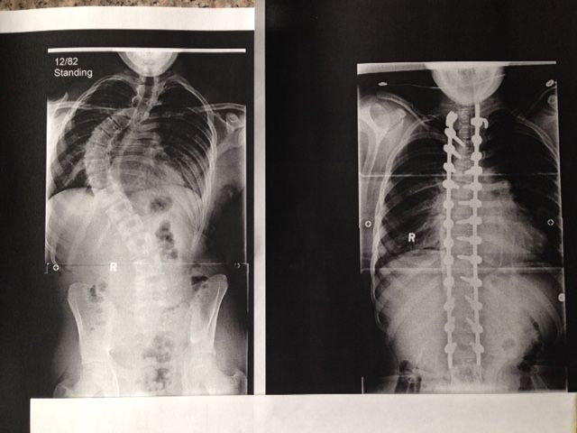 Before and After my surgery last week. I would like to thank everyone on this sub for making ...