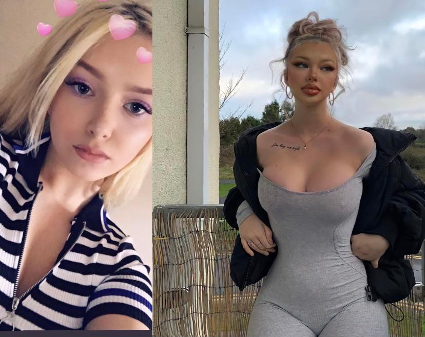 Before and after , the lip fillers really made me 100 times hotter | Scrolller