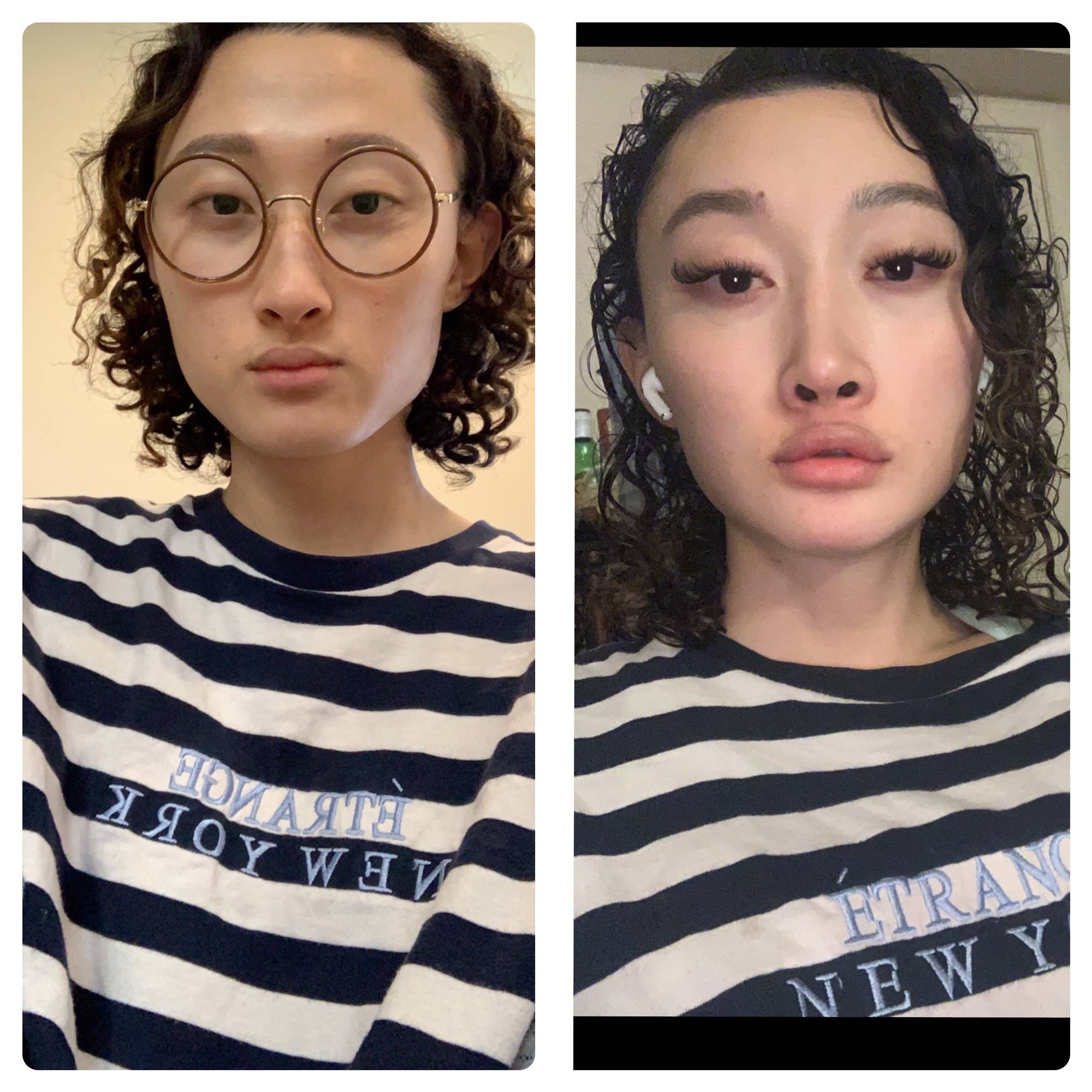 Before FFS //4 mo post op | Scrolller