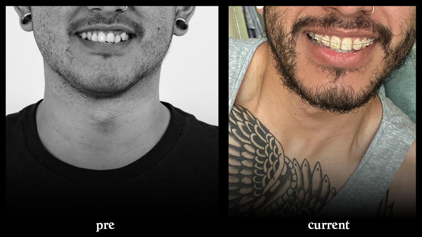 Best decision I made. 5 mo. progress from July 2020 – January 2021 | Scrolller