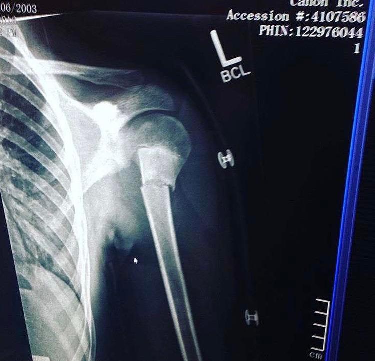Broken humerus, 2 week x-ray | Scrolller