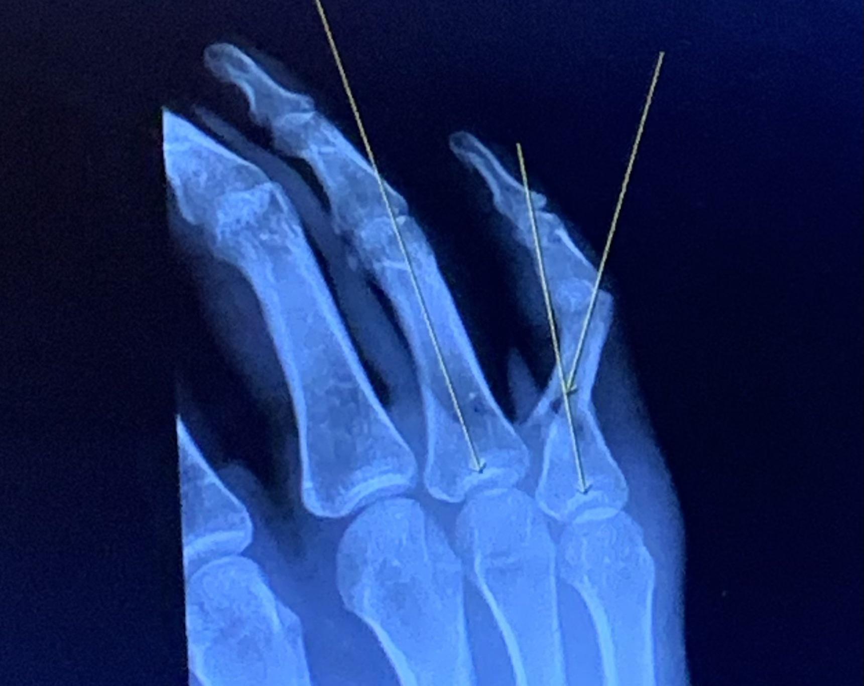 Broken pinky, also twisted about 90 degrees. Surgery was needed for sure. | Scrolller