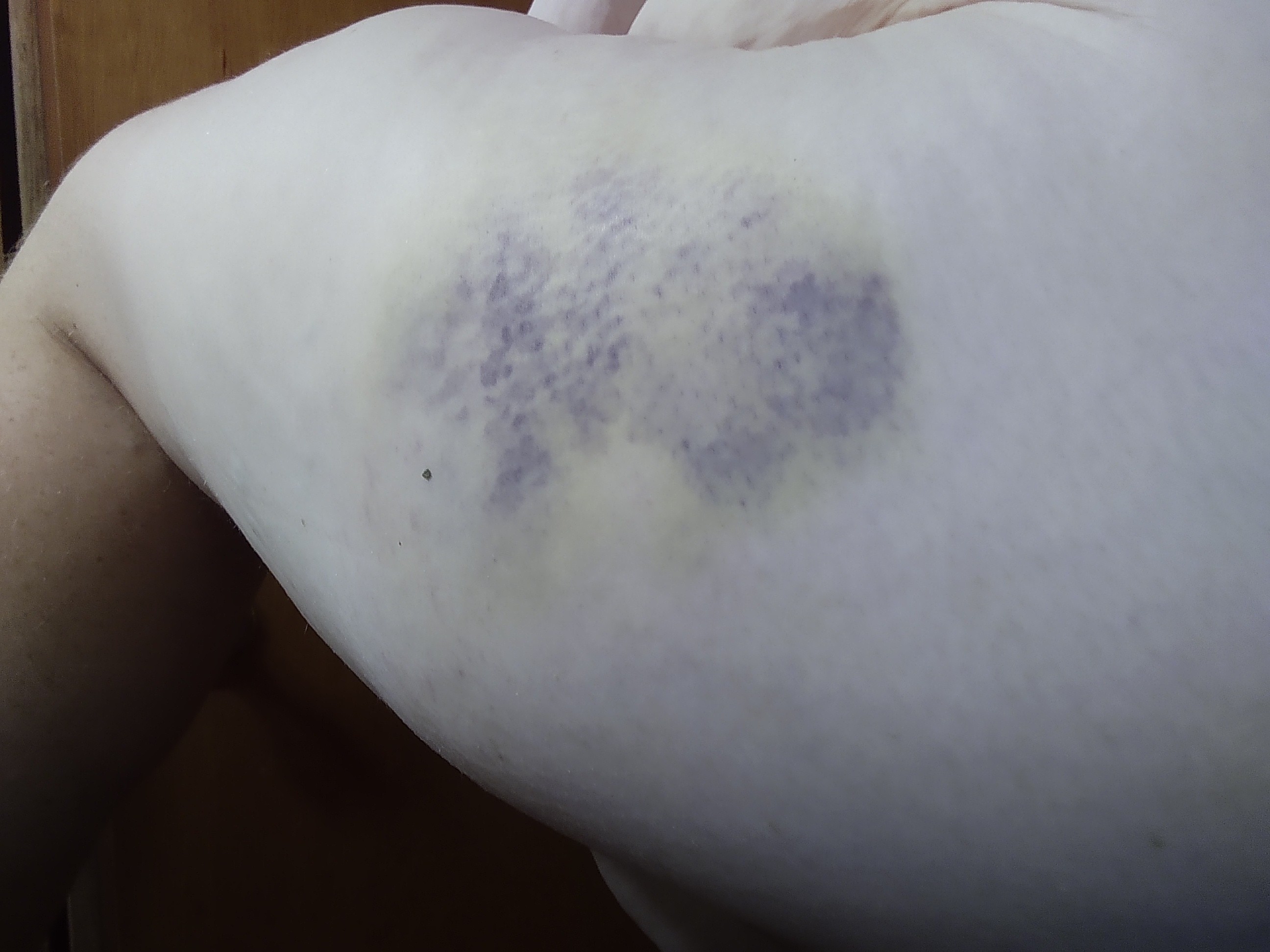 Bruise progression | Scrolller