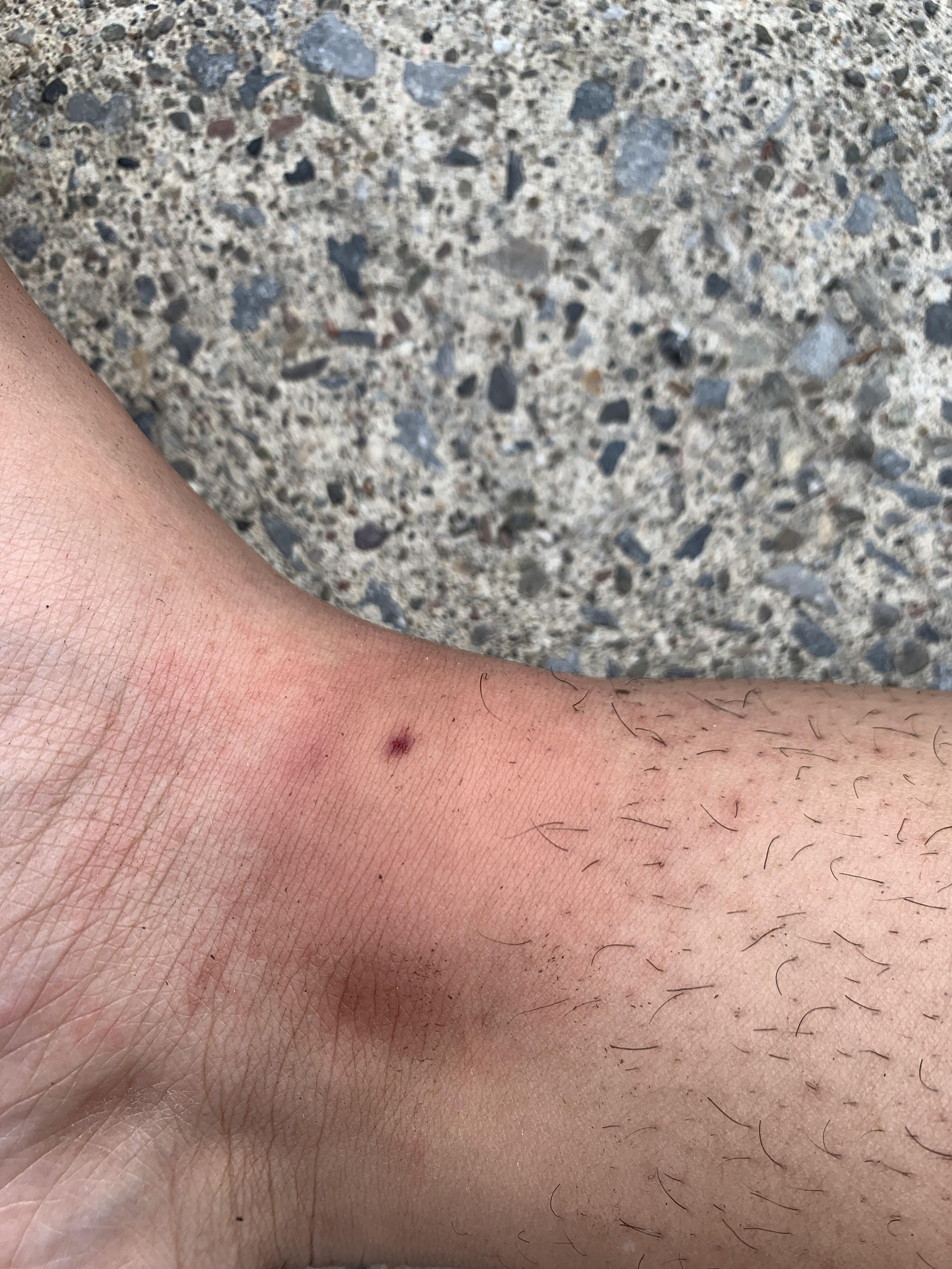 Bug bite? | Scrolller