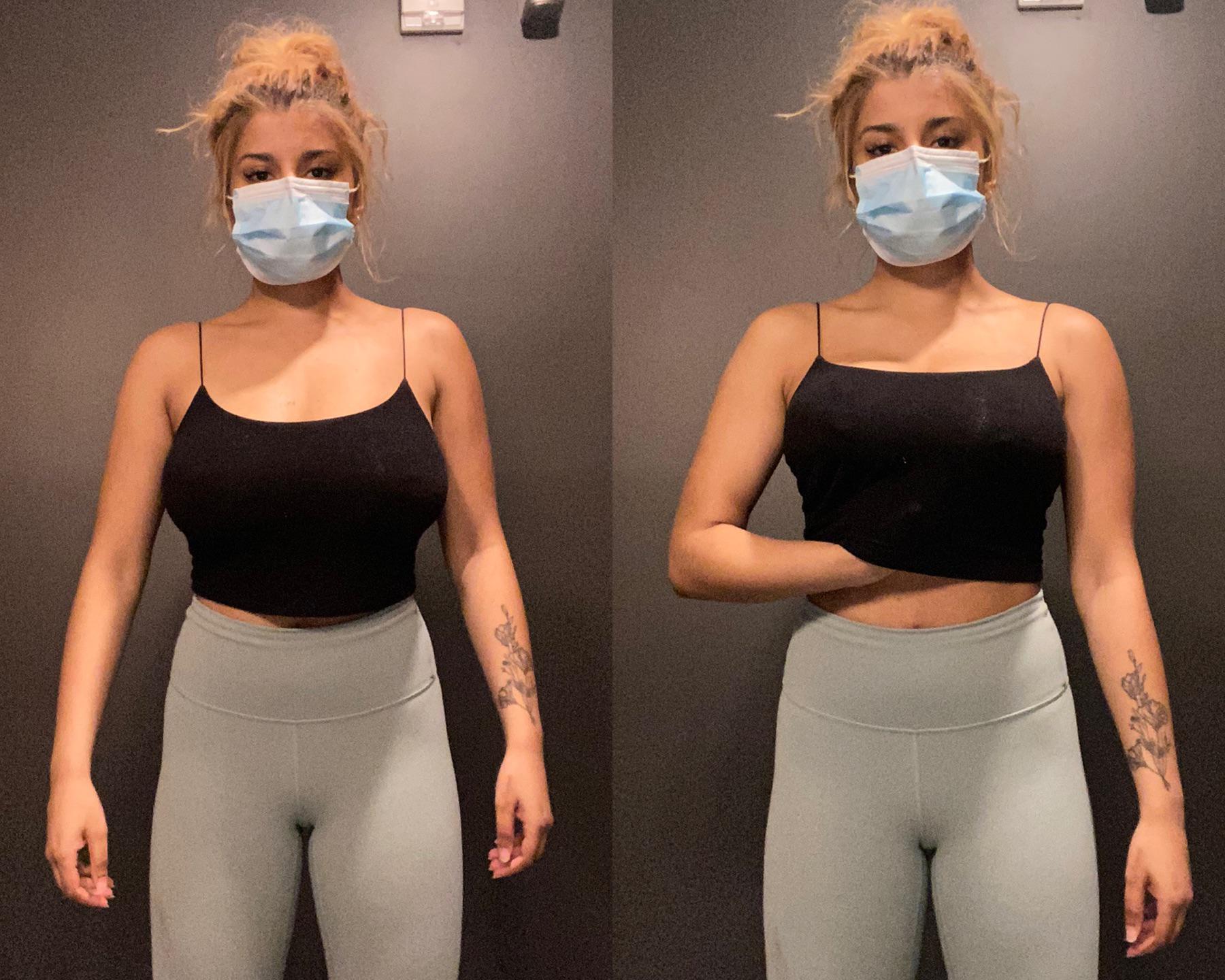 Considering breast reduction, which side is more aesthetically pleasing? | Scrolller