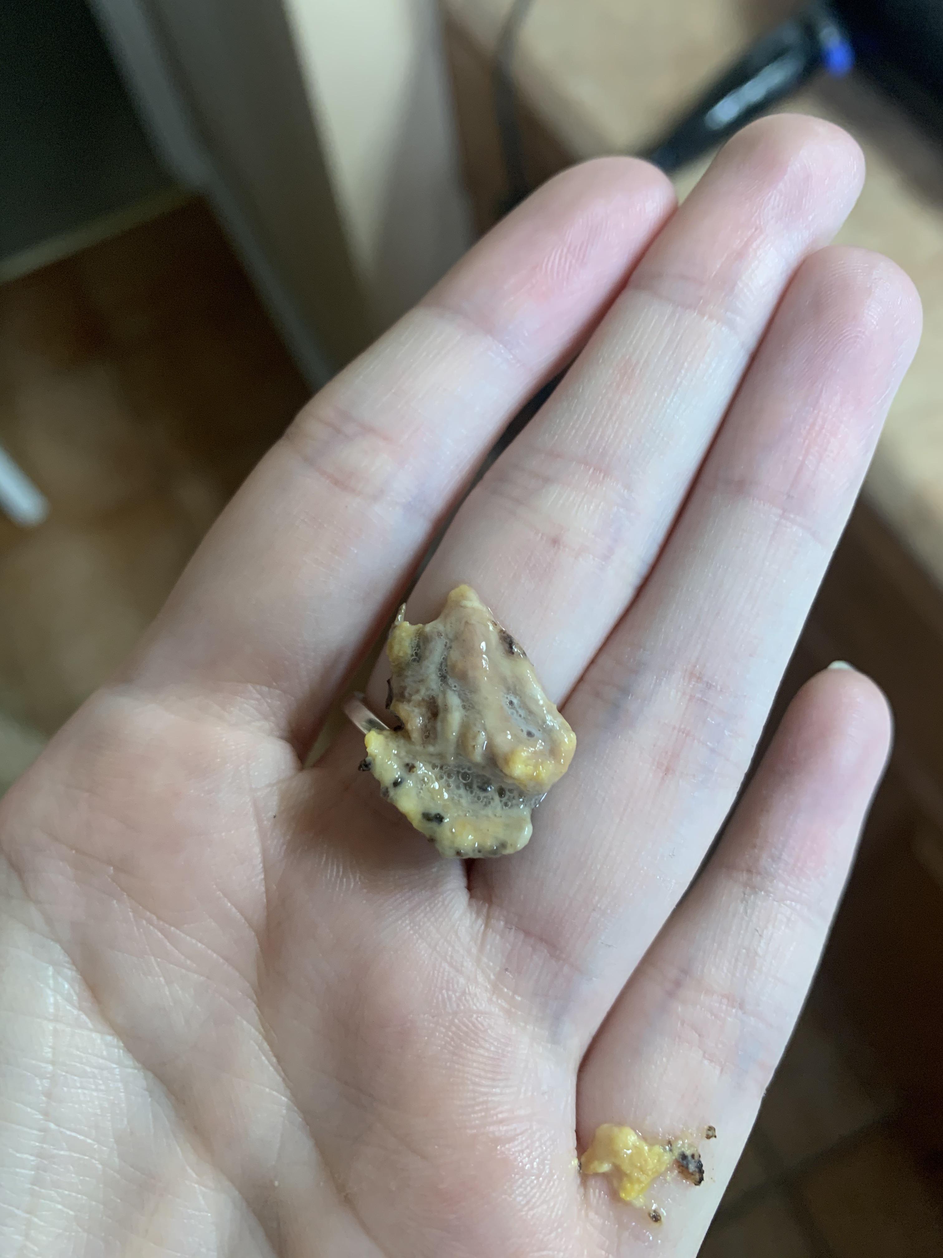 Coughed Up Massive Tonsillectomy Scab Scrolller Coughed Up Massive Tonsillectomy Scab Scrolller