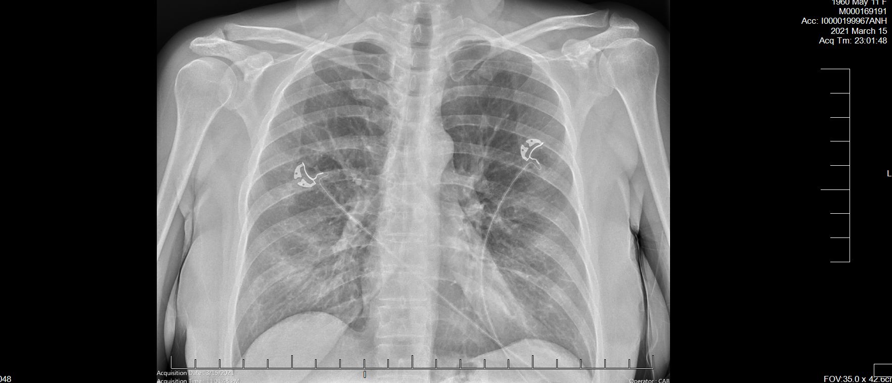covid x ray of lungs what am i looking at here? | Scrolller