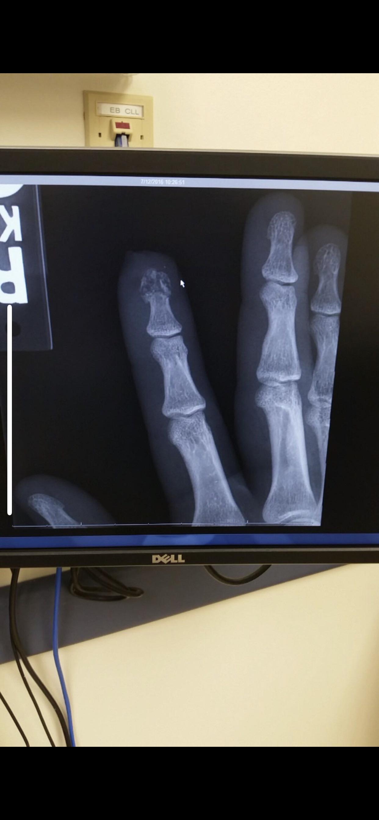 Crushed fingertip bone | Scrolller