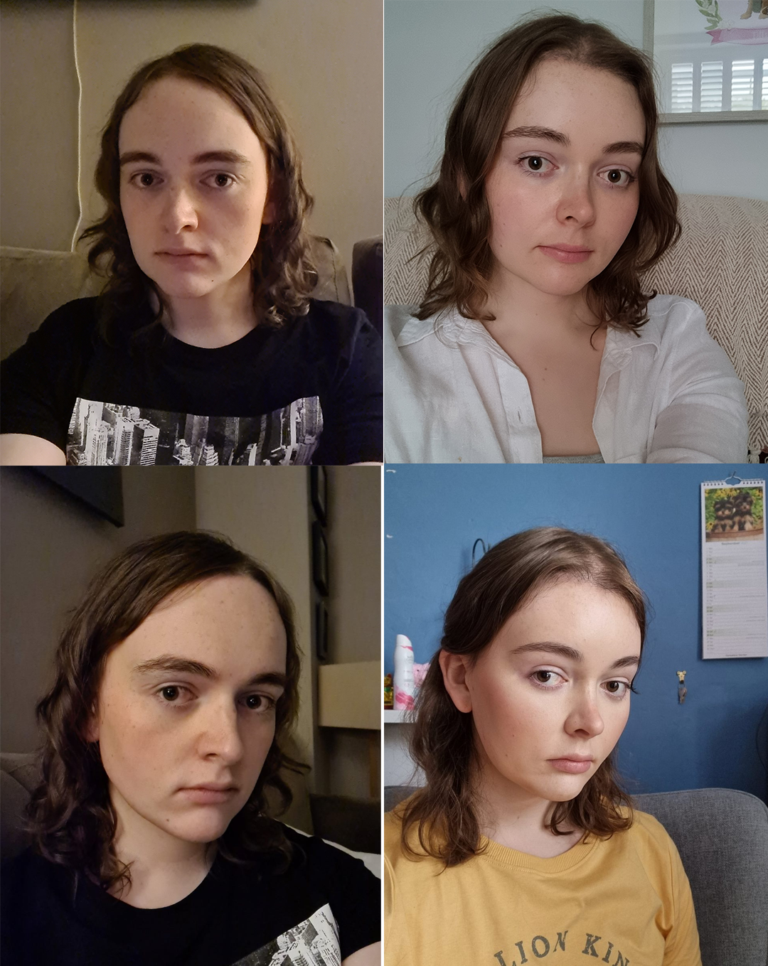 Deschamps-Braly 1 year post-op | Scrolller