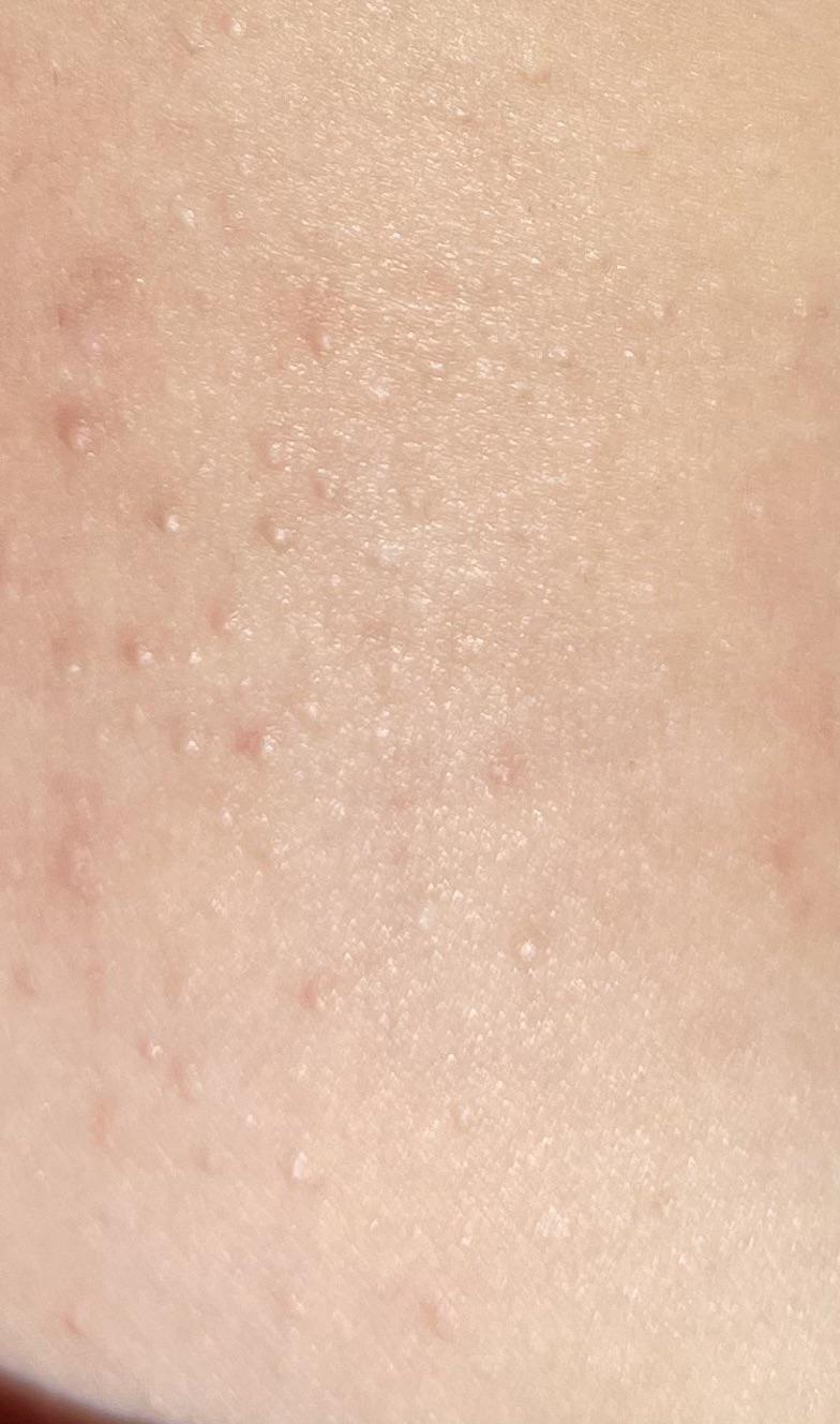Does anyone else’s folliculitis present like this? | Scrolller