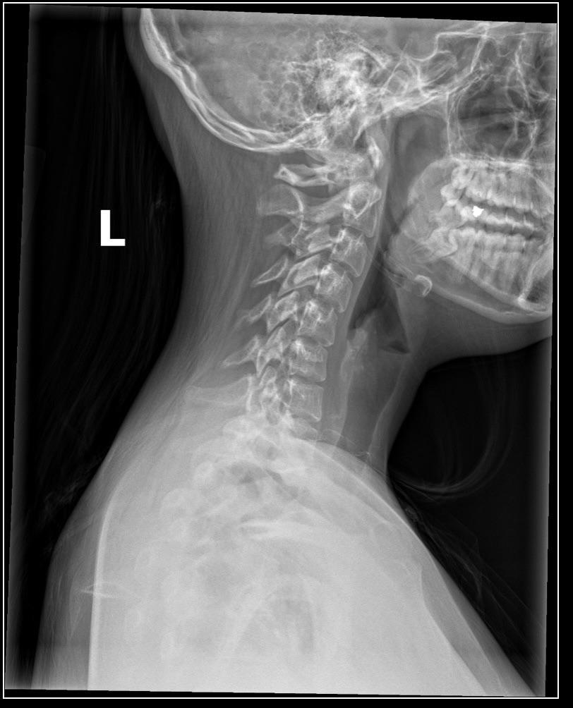 Ehlers Danlos Syndrome Danlos Neck X-Ray | Scrolller