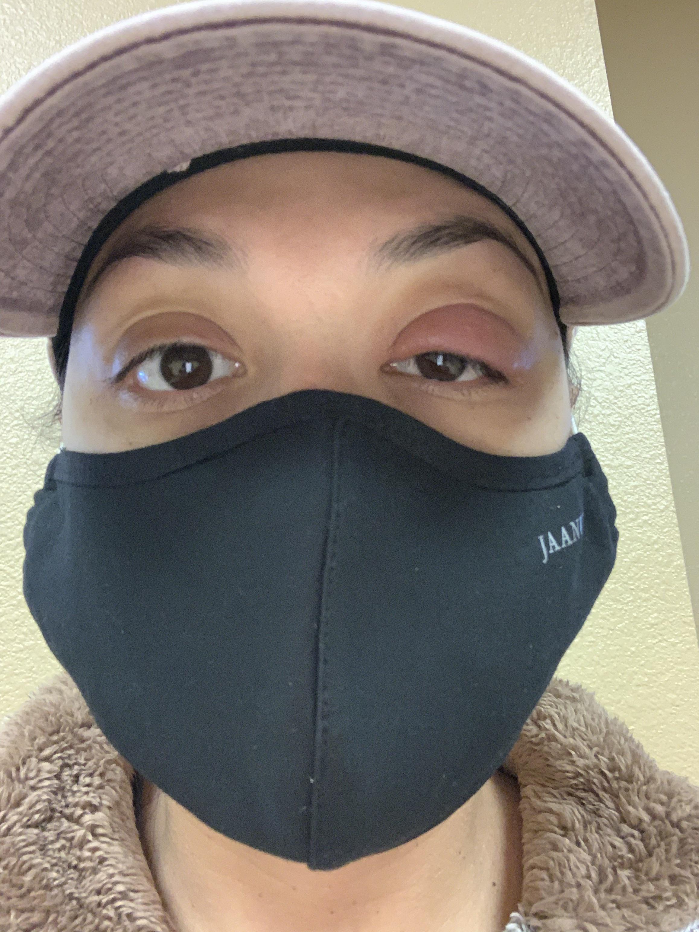 Eyelid Update: it’s infected! | Scrolller