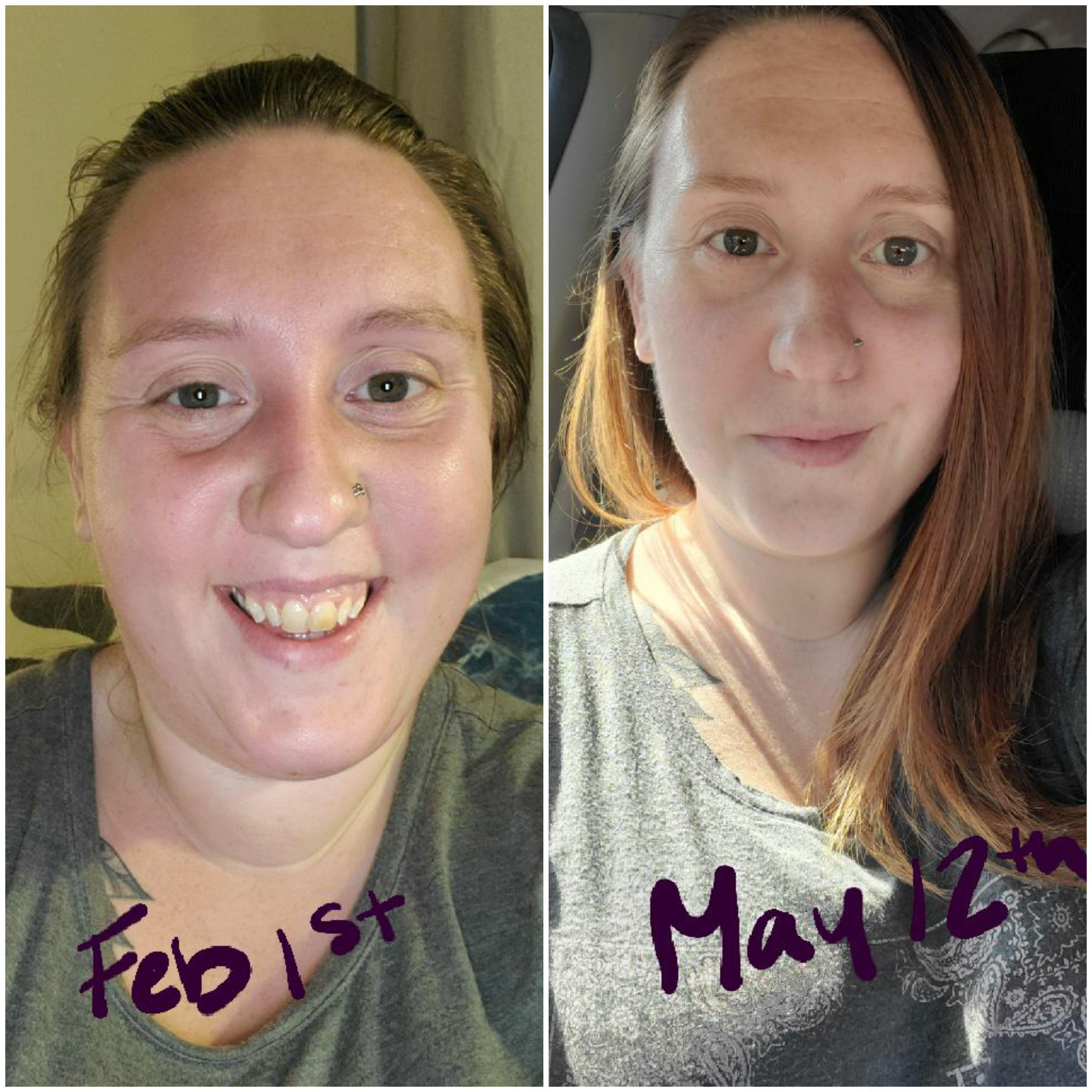 Face gains! 31lbs down thanks to CICO! | Scrolller