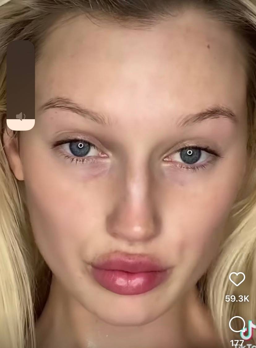 Filler migration is real | Scrolller