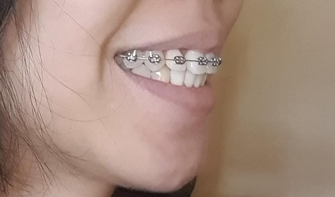 Flared teeth | Scrolller