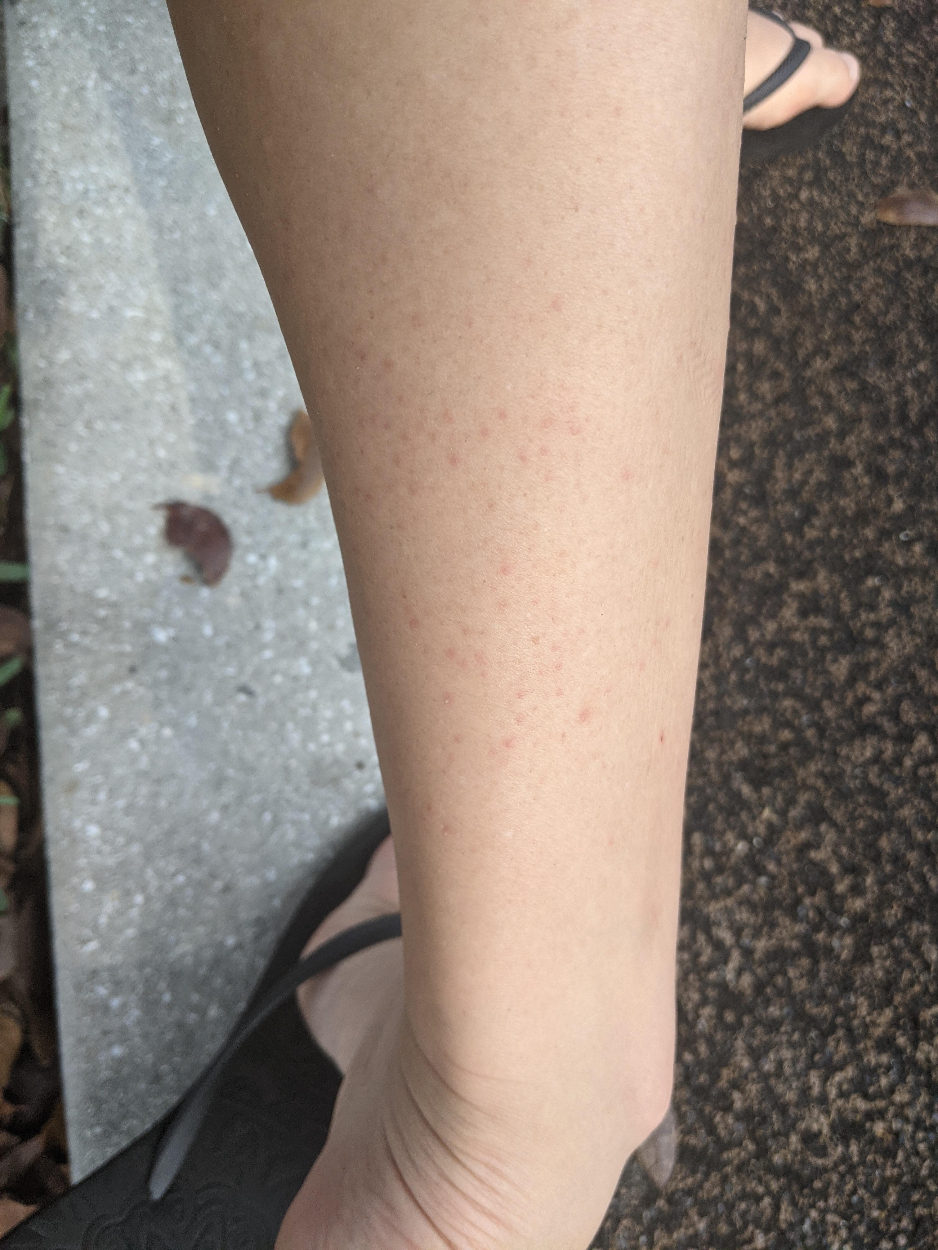 Folliculitis or KP? And where to start for treatment? | Scrolller