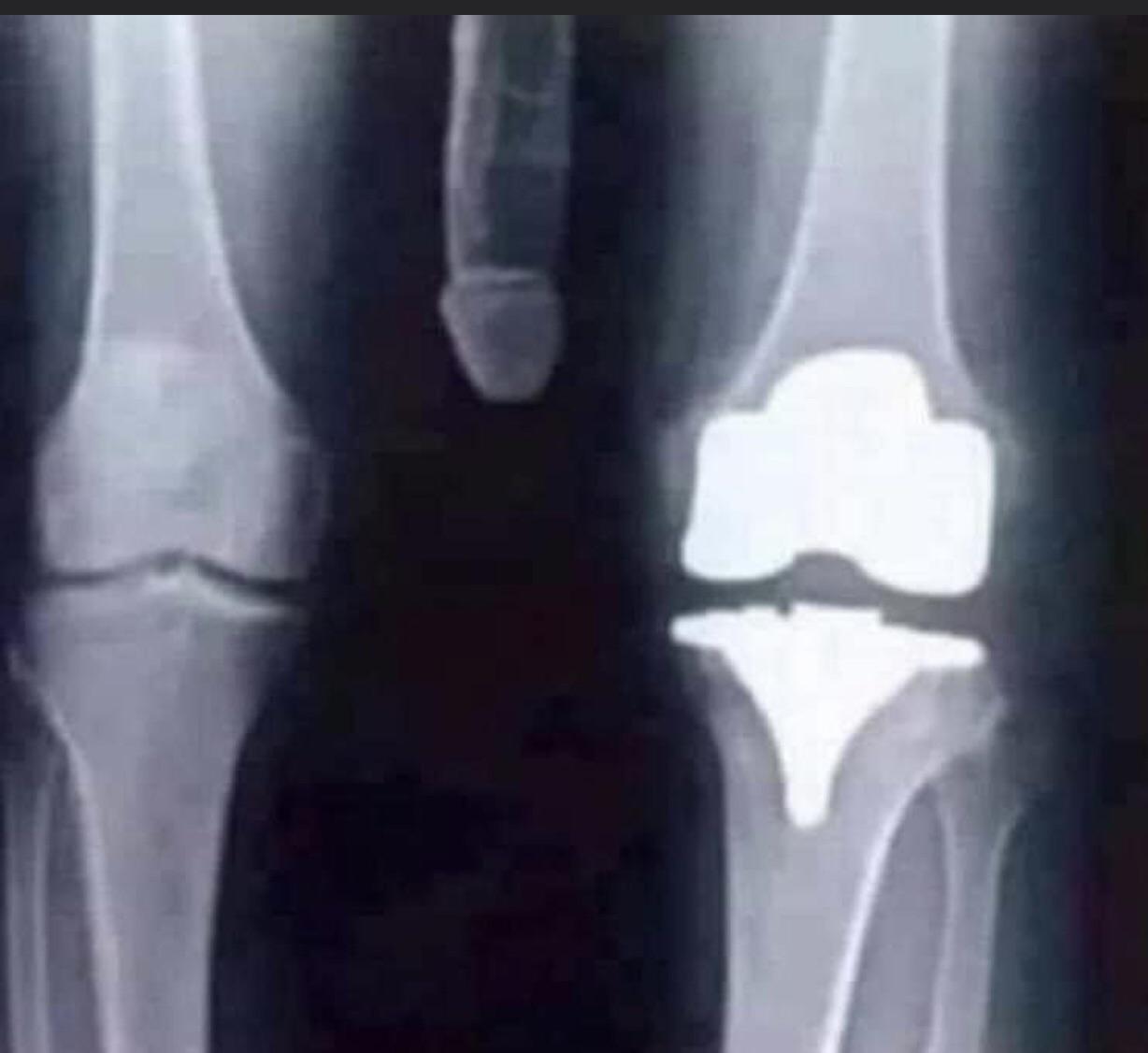 Glad my knee replacement was a success! | Scrolller