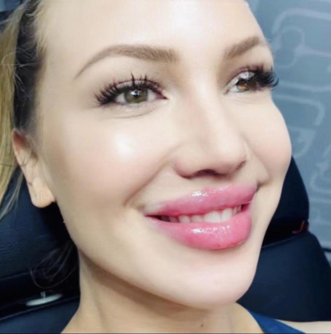 Had my lips filled for the first. Someone said I look like bimbo? To much? | Scrolller