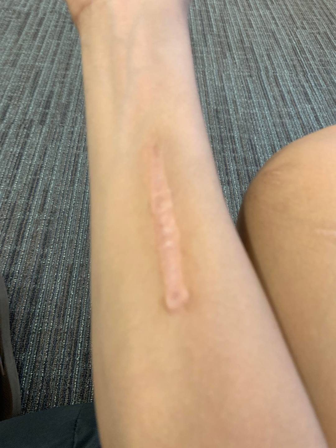 Here is a picture of my arm post surgery | Scrolller