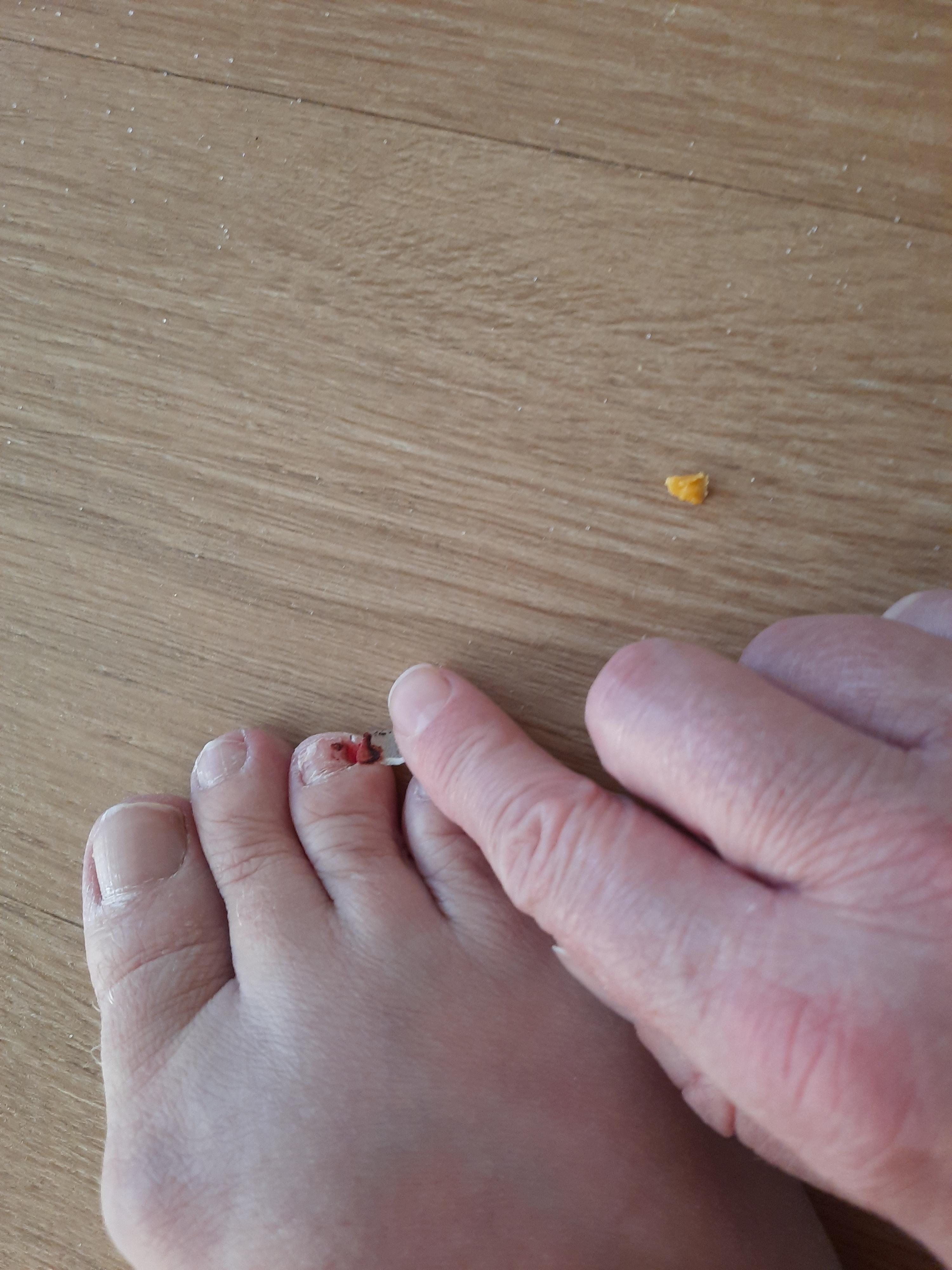 I crushed my toenail and now it's falling off. Ugh.😫 | Scrolller