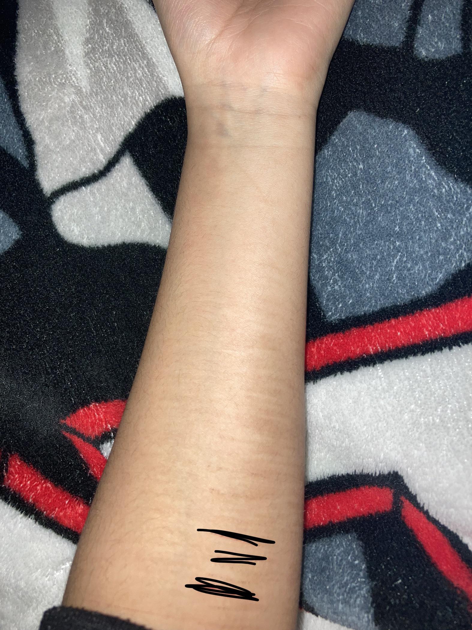 I was caught doing it on my arm but anyway here’s the healing 🦧 | Scrolller