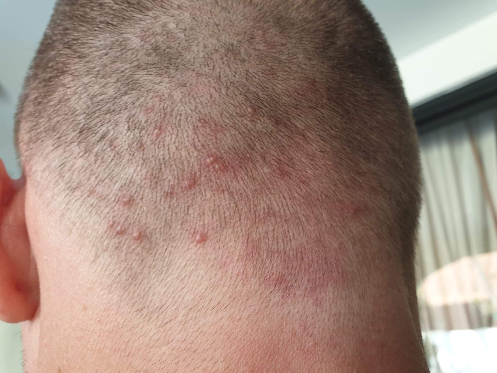 Is this Folliculitis? | Scrolller