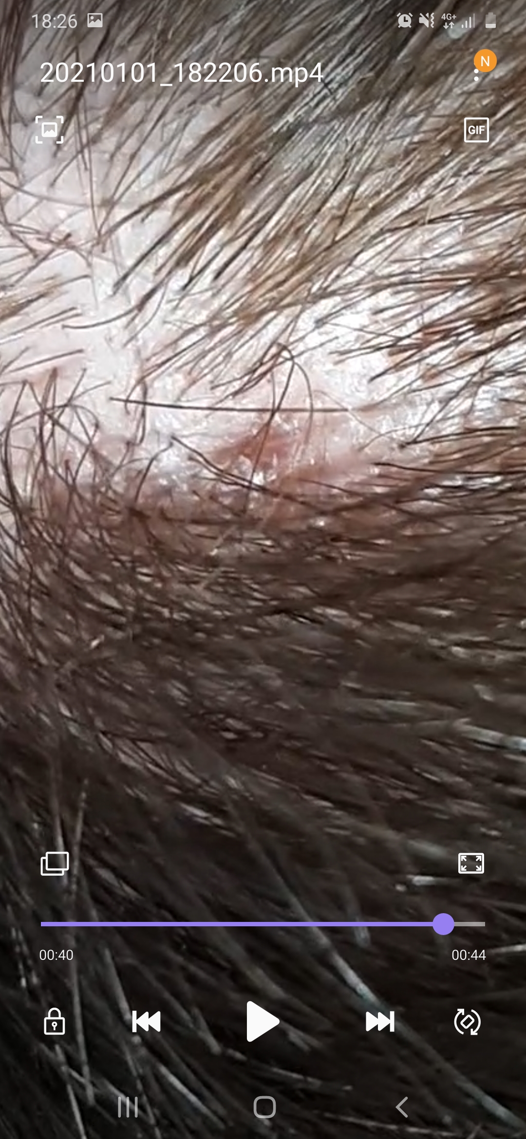 Is this Folliculitis Decalvans? | Scrolller