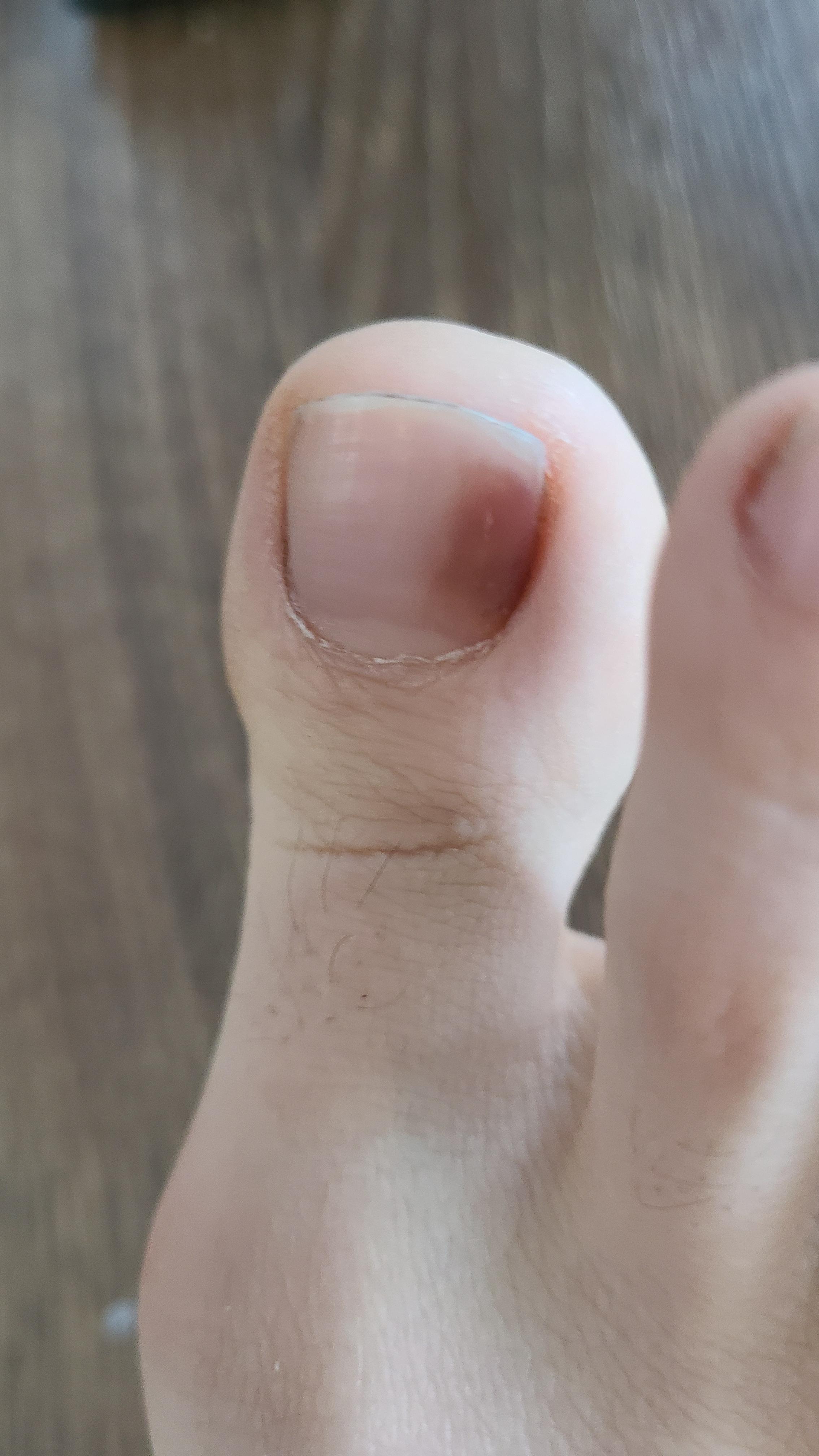 Is this nail melanoma?... | Scrolller