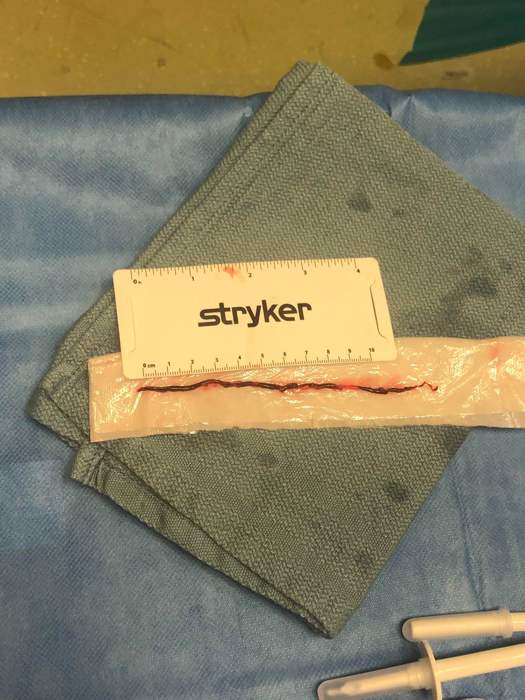 Left MCA clot after thrombectomy (stroke patient) | Scrolller