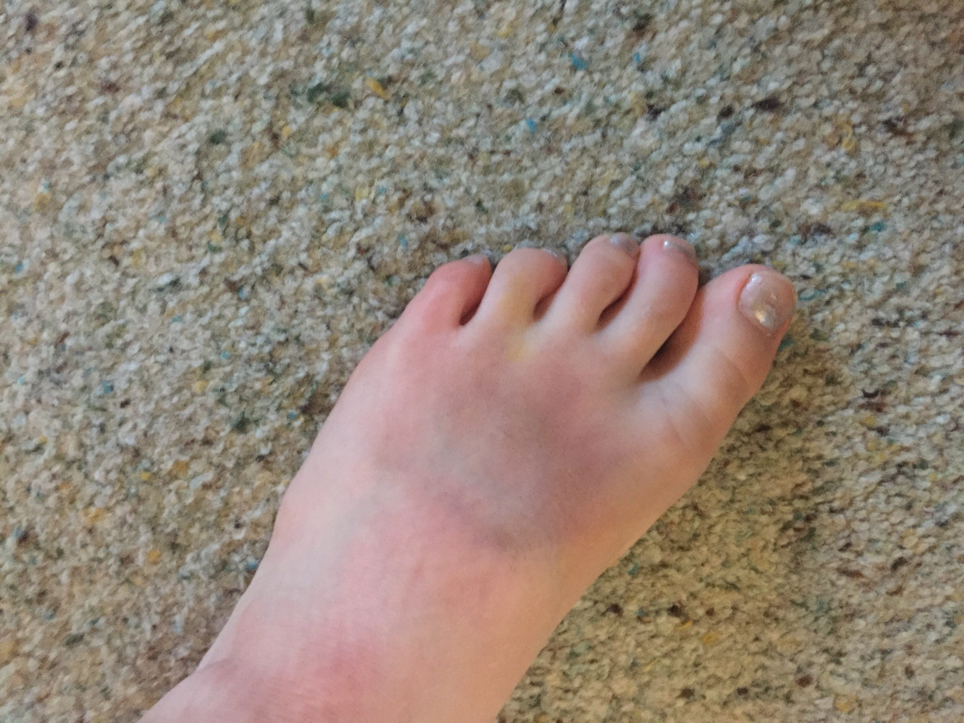 Light bruise. Feedback welcome | Scrolller