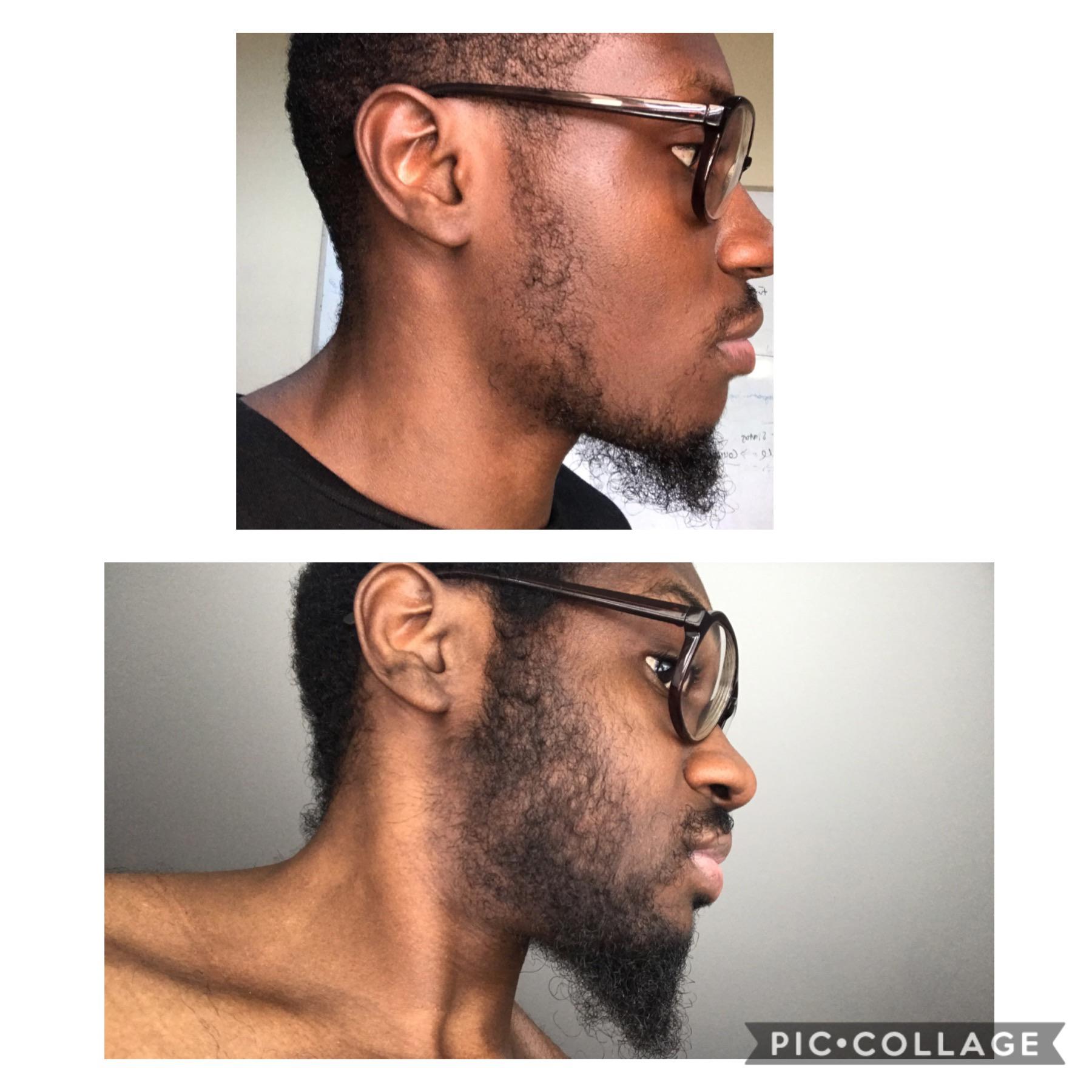 Minoxidil beard 3 month transformation. Routine down in comments ...