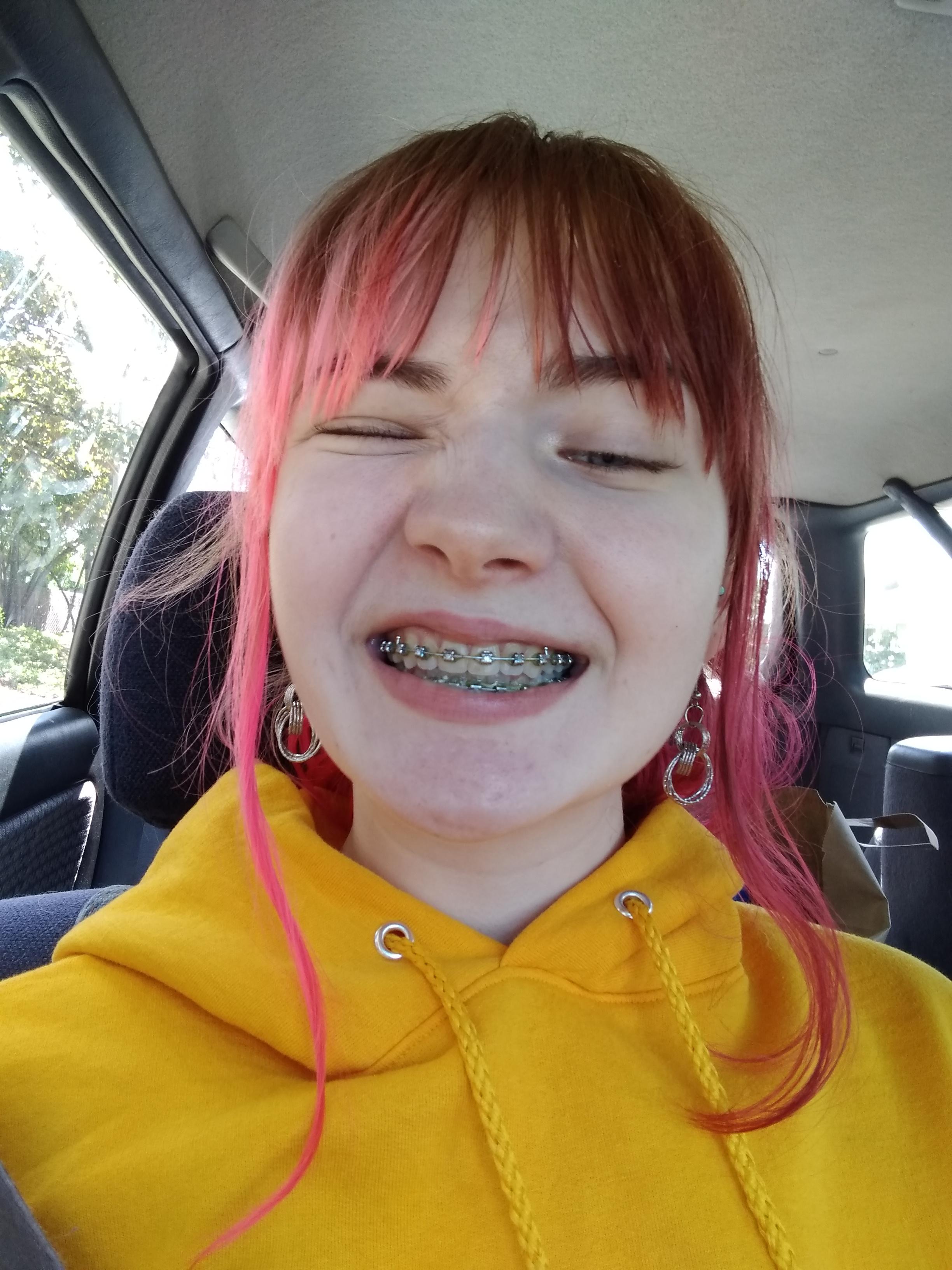 My Brace Face | Scrolller