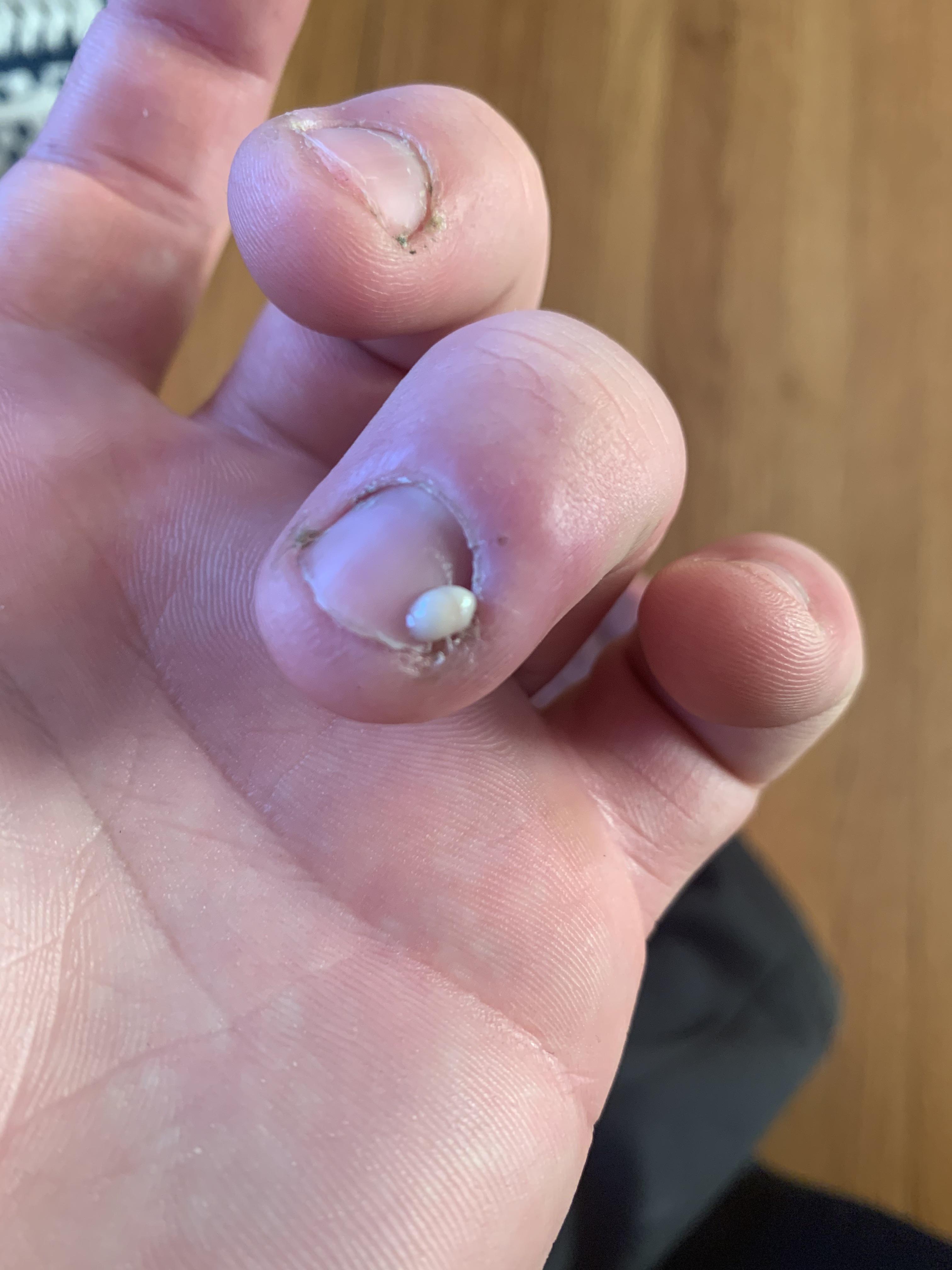 My hangnail finally exploded | Scrolller