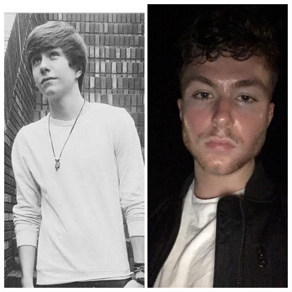 My jaw progress 2014-2019 | Scrolller