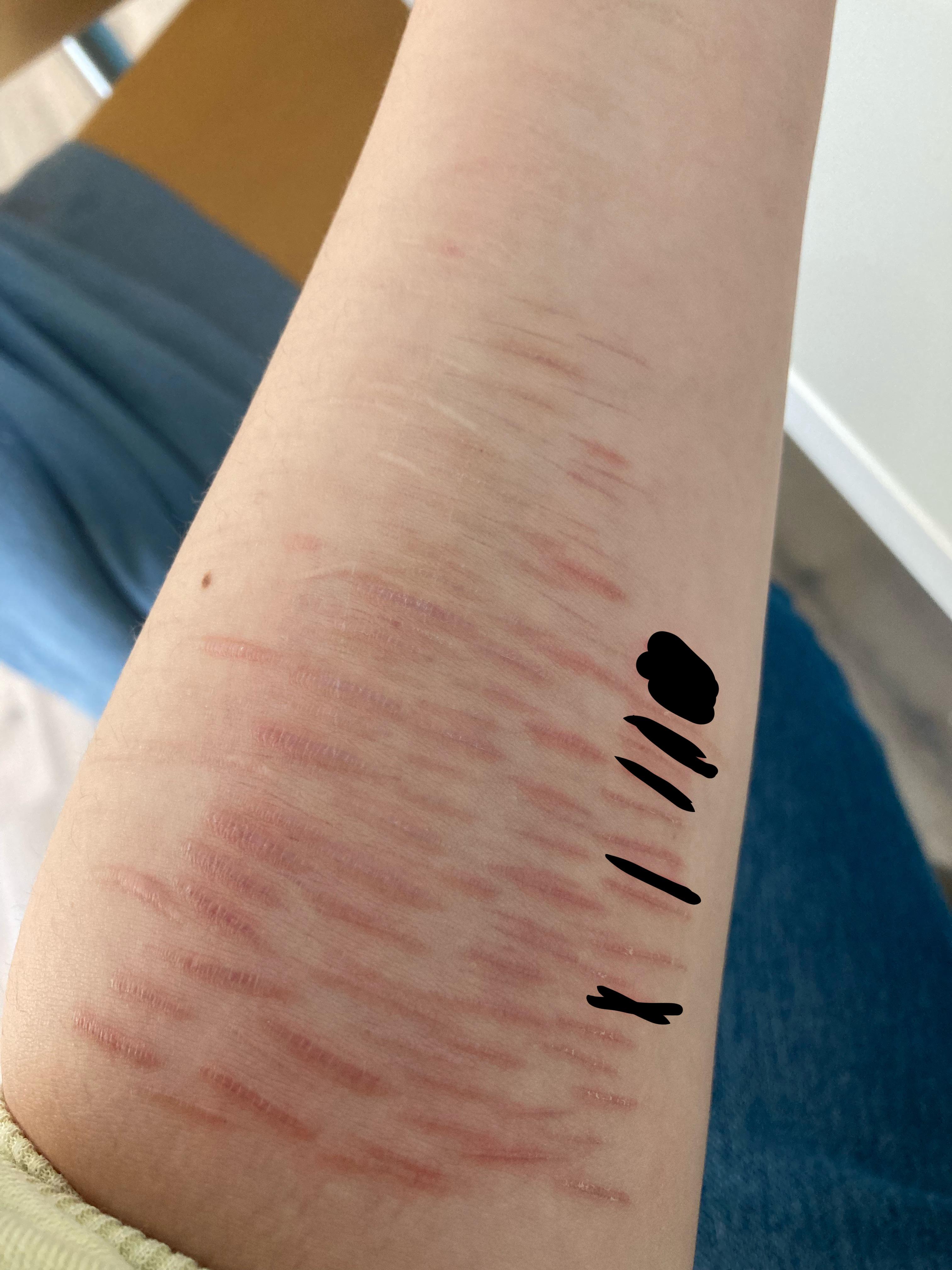 My scars on my arm | Scrolller