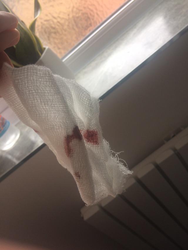 (NSFW) is this a normal amount of bleeding to wake up to 3 days post op? | Scrolller