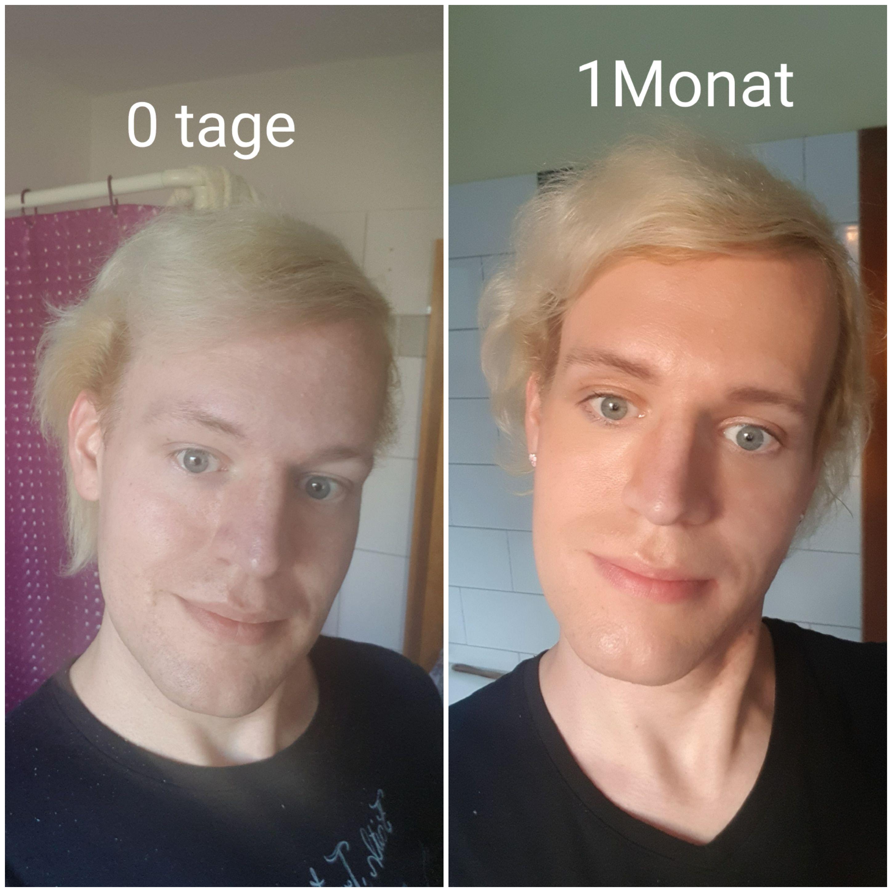 One mouth on hormones. No big difference 😔 | Scrolller