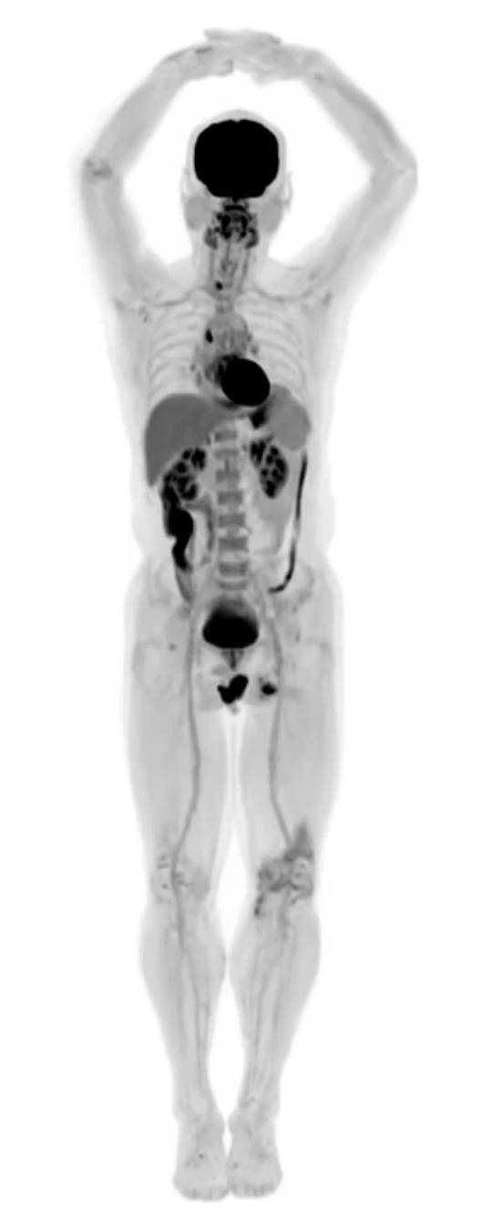 PET/CT scan from EXPLORER, the world's first medical imaging scanner that can capture a 3-D ...