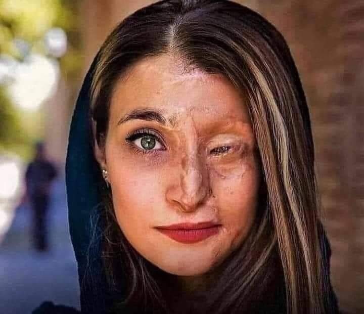 /r/pics: Picture of an acid terrorrism victim | Scrolller