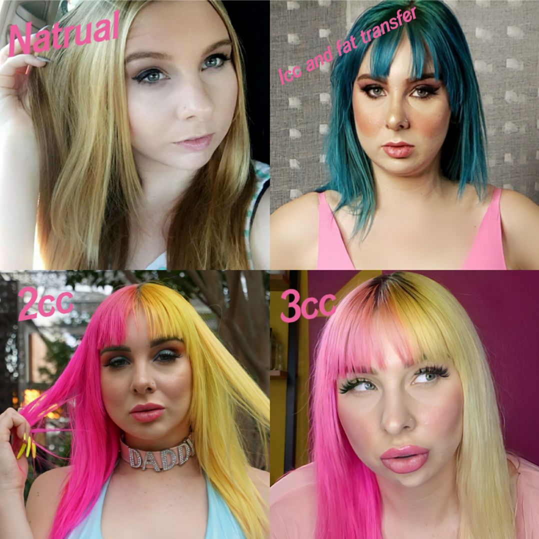 Plastic Fantastic: Lip Transformation | Scrolller