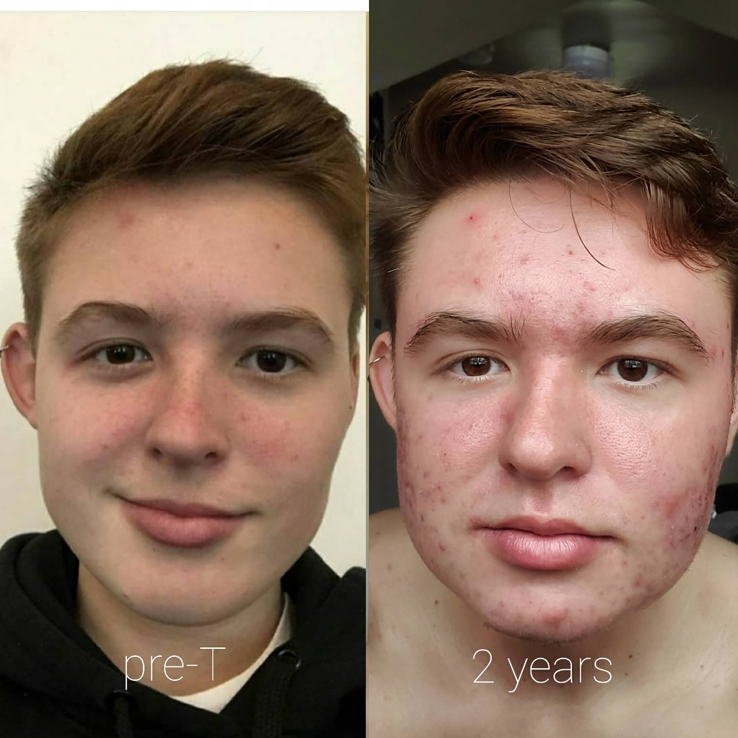 Pre-T to 2 years on T! | Scrolller