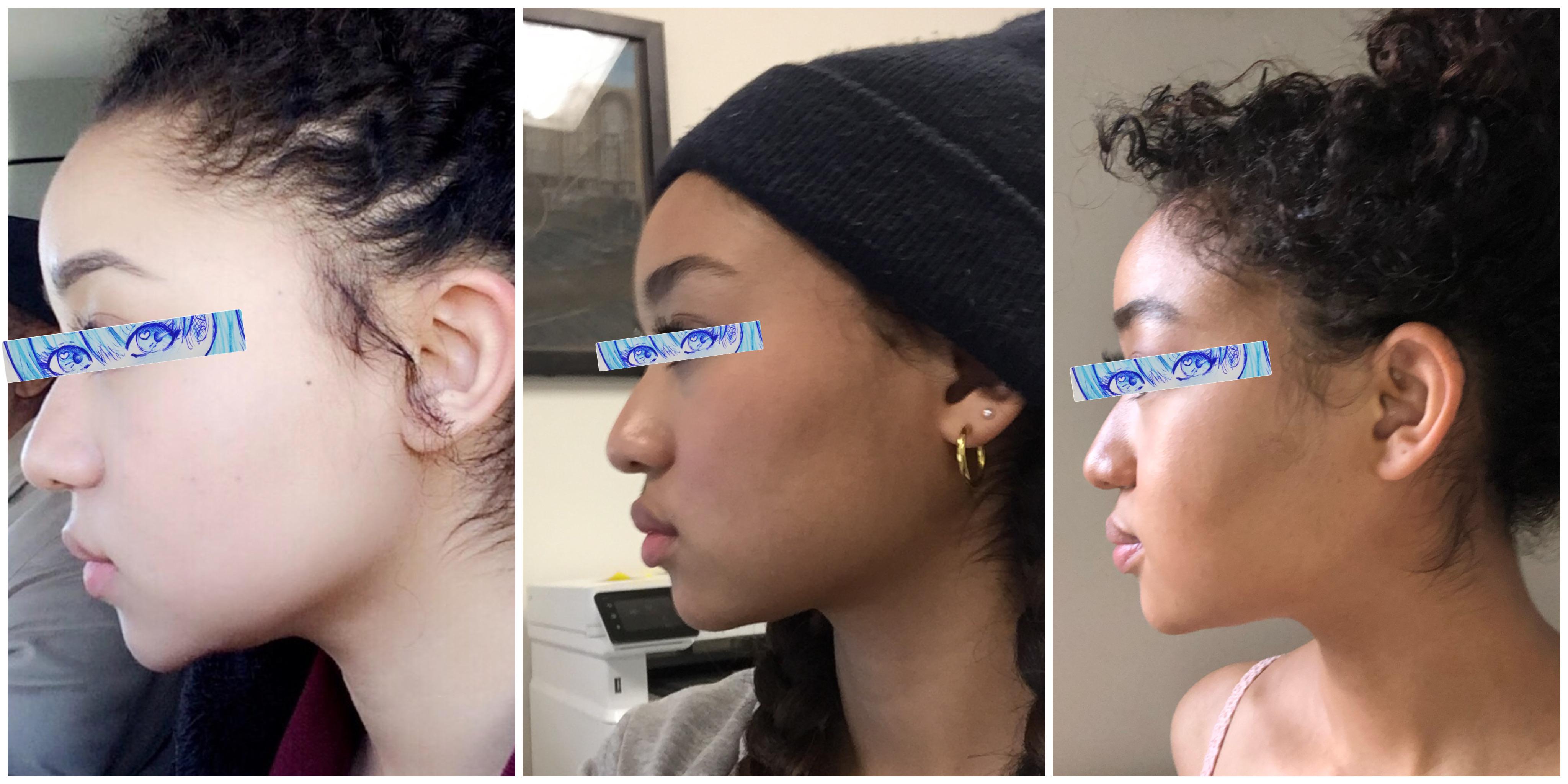 progress photos - 2017>2018>2019. no real consistent "mewing" just ...