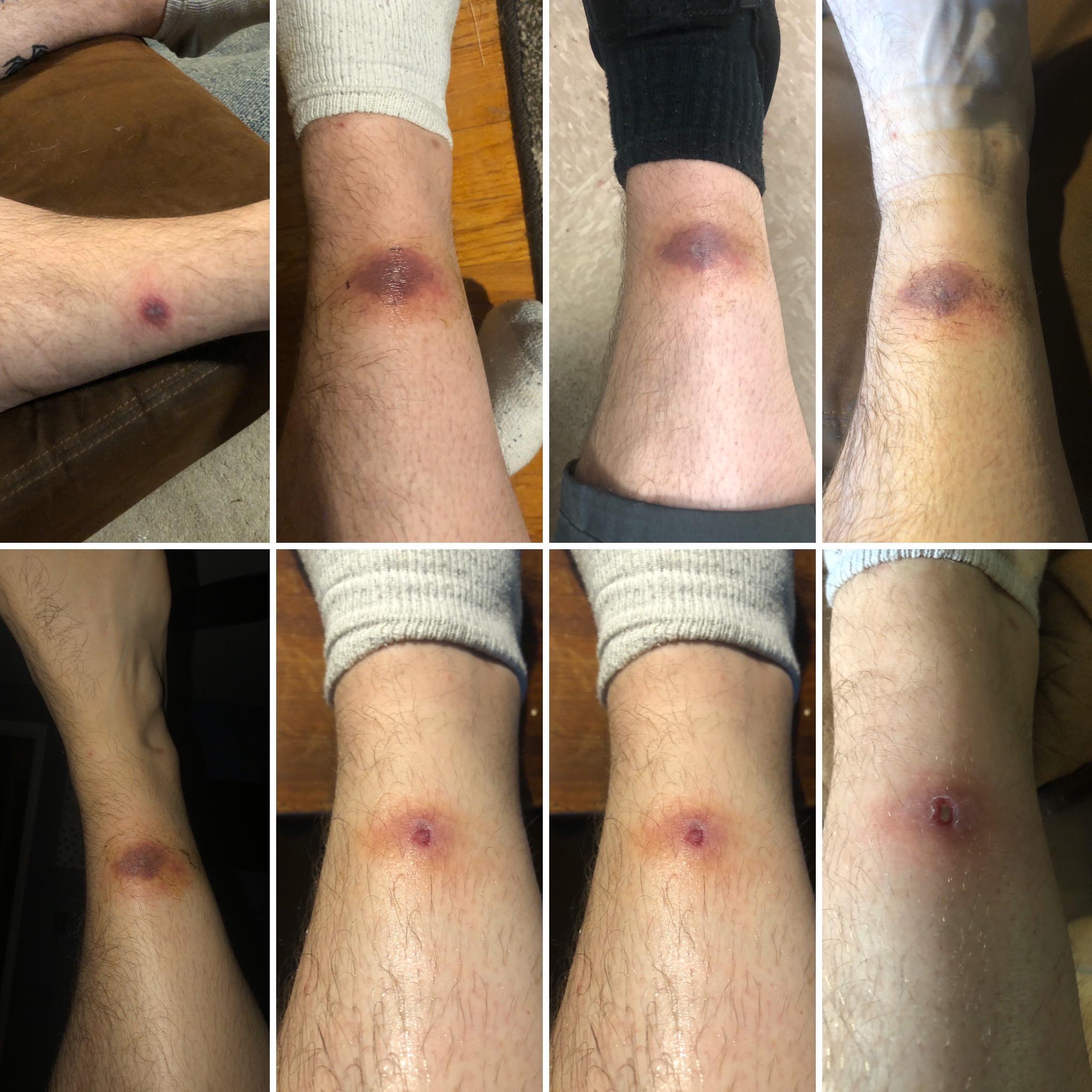 Progression of an infected wasp sting | Scrolller