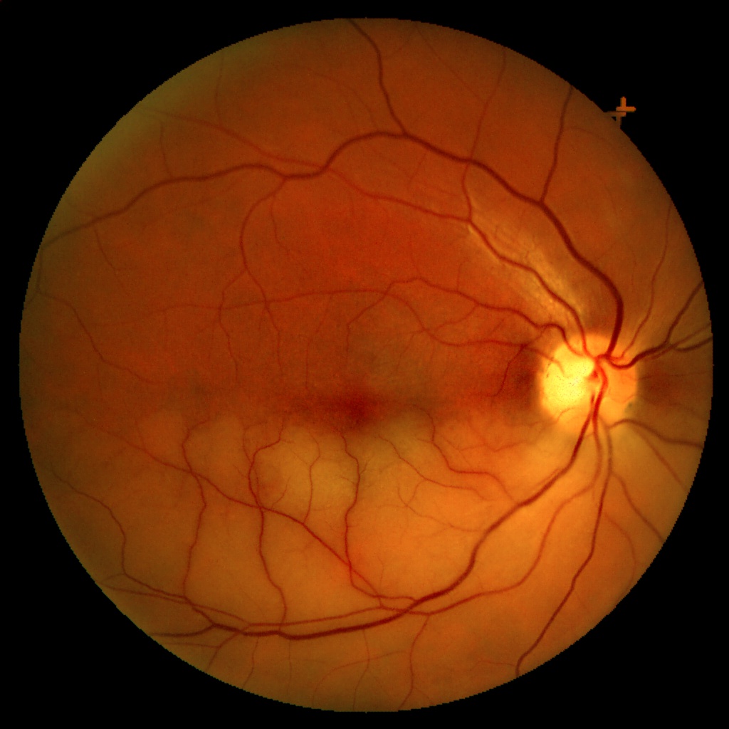 Retinal artery occlusion | Scrolller