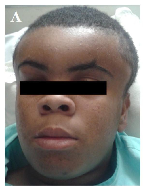 Sinusitis complication - Periorbital edema requiring surgical drainage | Scrolller