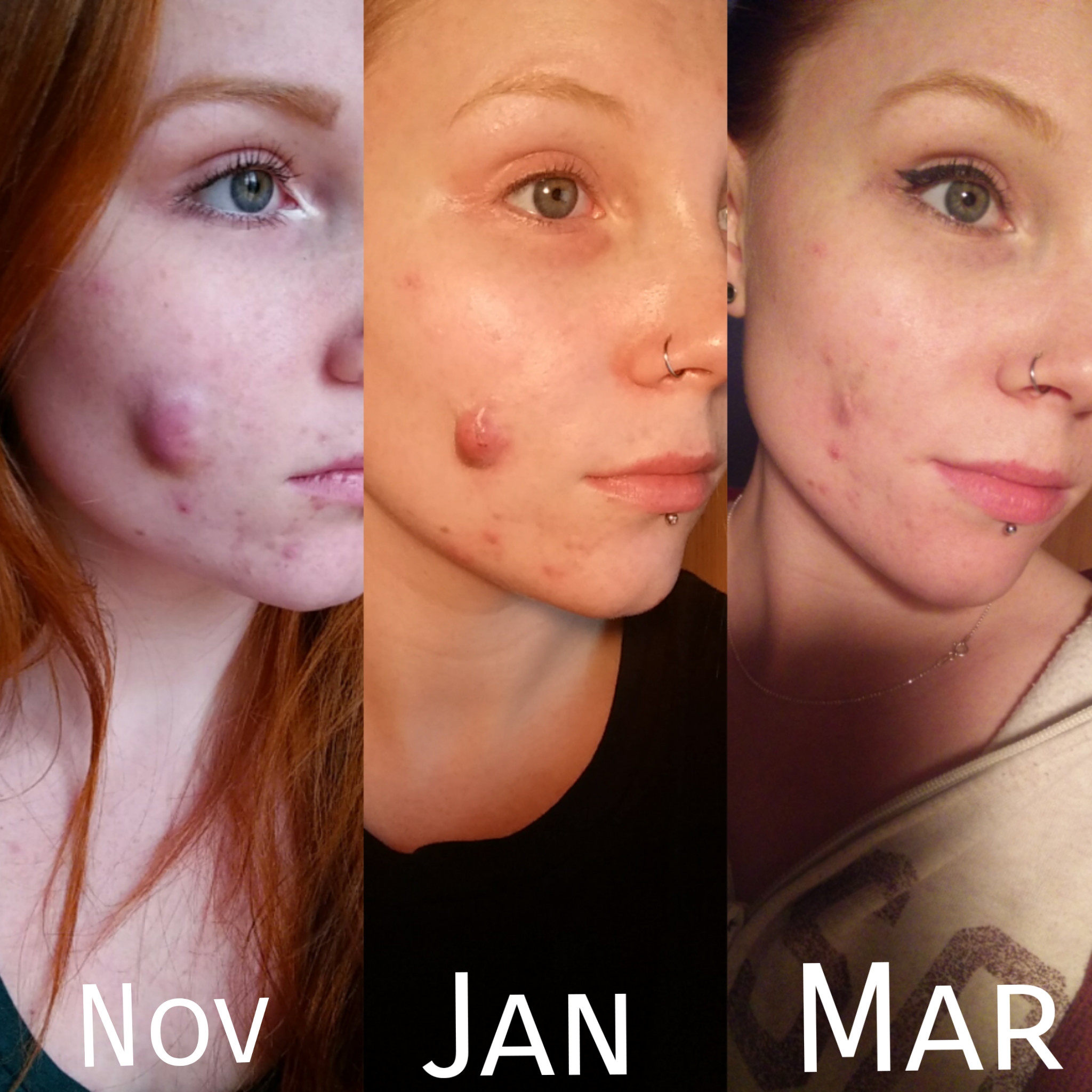 [skin concerns] UPDATE: Cheek cyst progress.... 5 months later :) | Scrolller