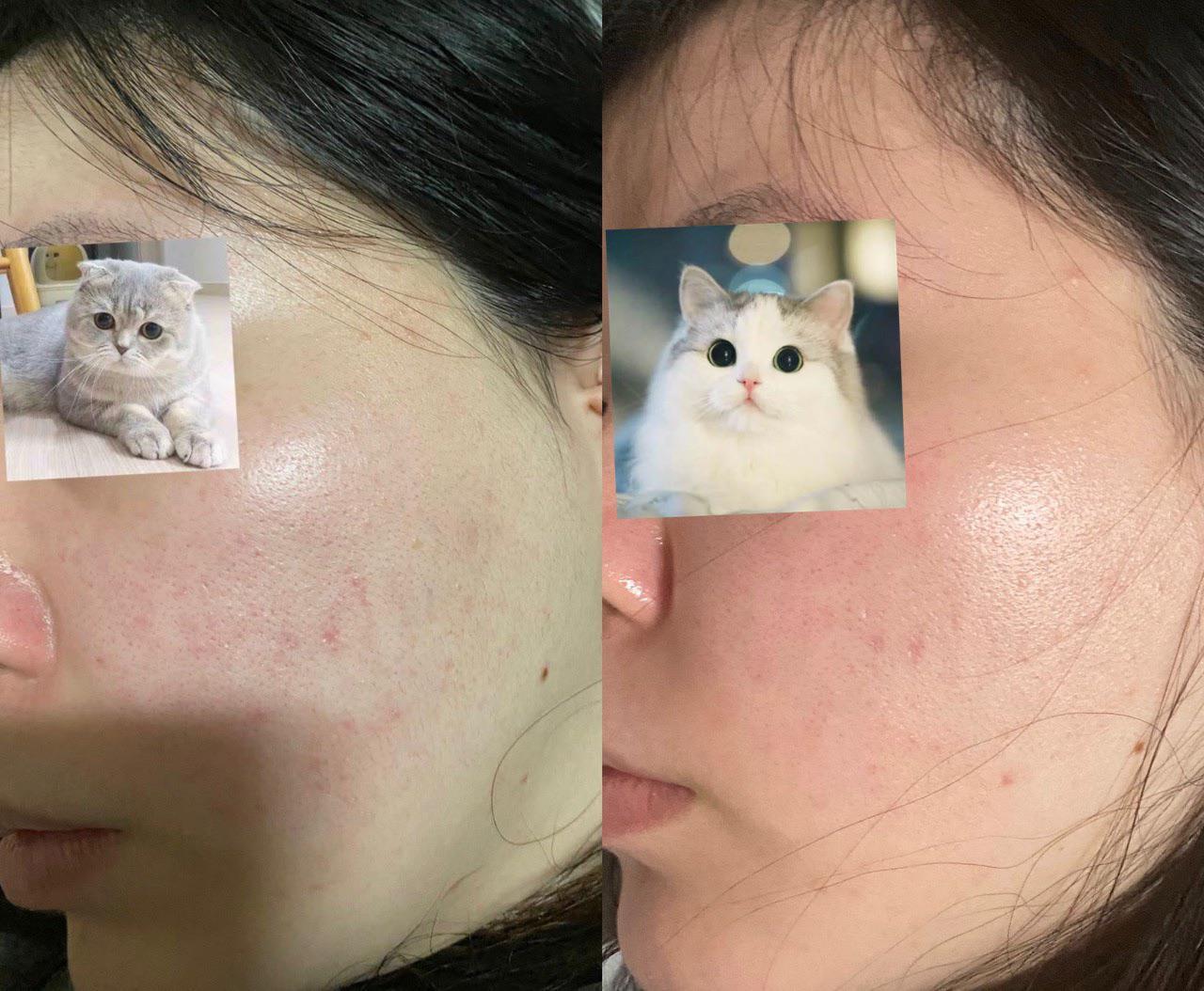 Soolantra + AzA two month progress pic. My skin feels healthier. Can you see a difference ...